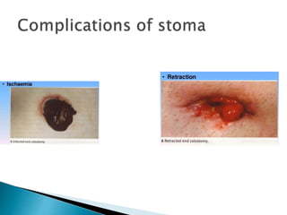 Stoma in surgery | PPT