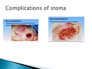 Stoma in surgery | PPT