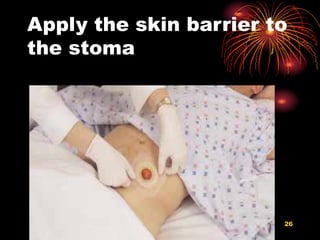 Stoma | PPT