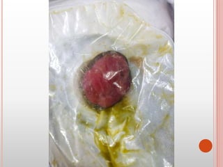 Loop ileostomy | PPTX