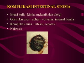 Ilmiah 1 Stoma Optek Bedah Digestive .ppt