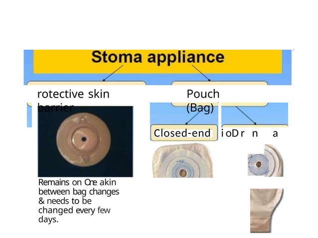 stoma introduction-preerparation and post stoma care | PPT