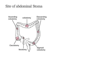 stoma introduction-preerparation and post stoma care | PPTX