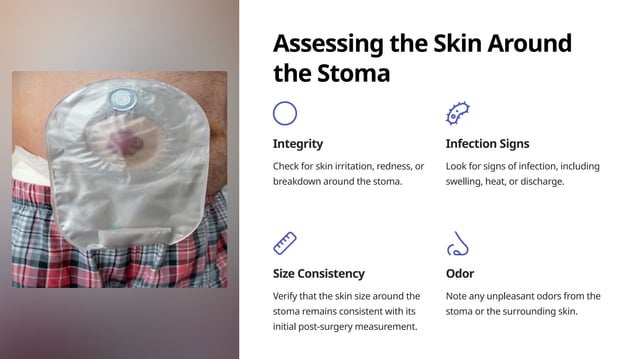 Stoma or (ileostomy and colostomy )and Nursing Care | PPT