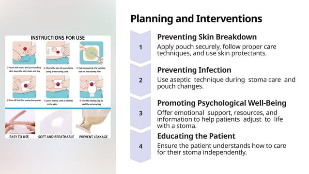 Stoma or (ileostomy and colostomy )and Nursing Care | PPT