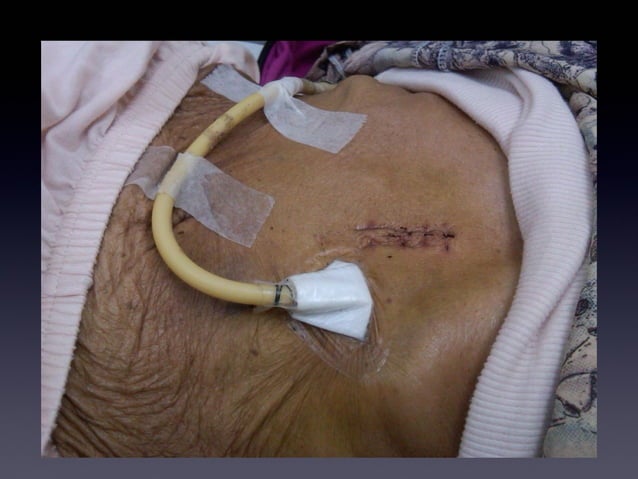 Stoma Therapy - Surgical Nursing | PPT | Digestive Disorders | Diseases ...