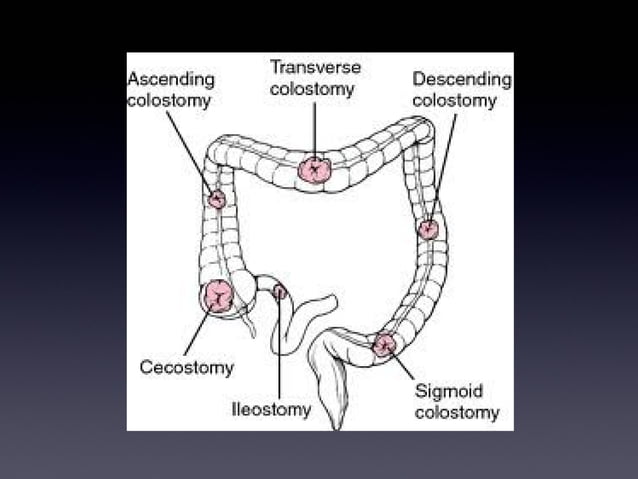 Stoma Therapy - Surgical Nursing | PPT | Digestive Disorders | Diseases ...