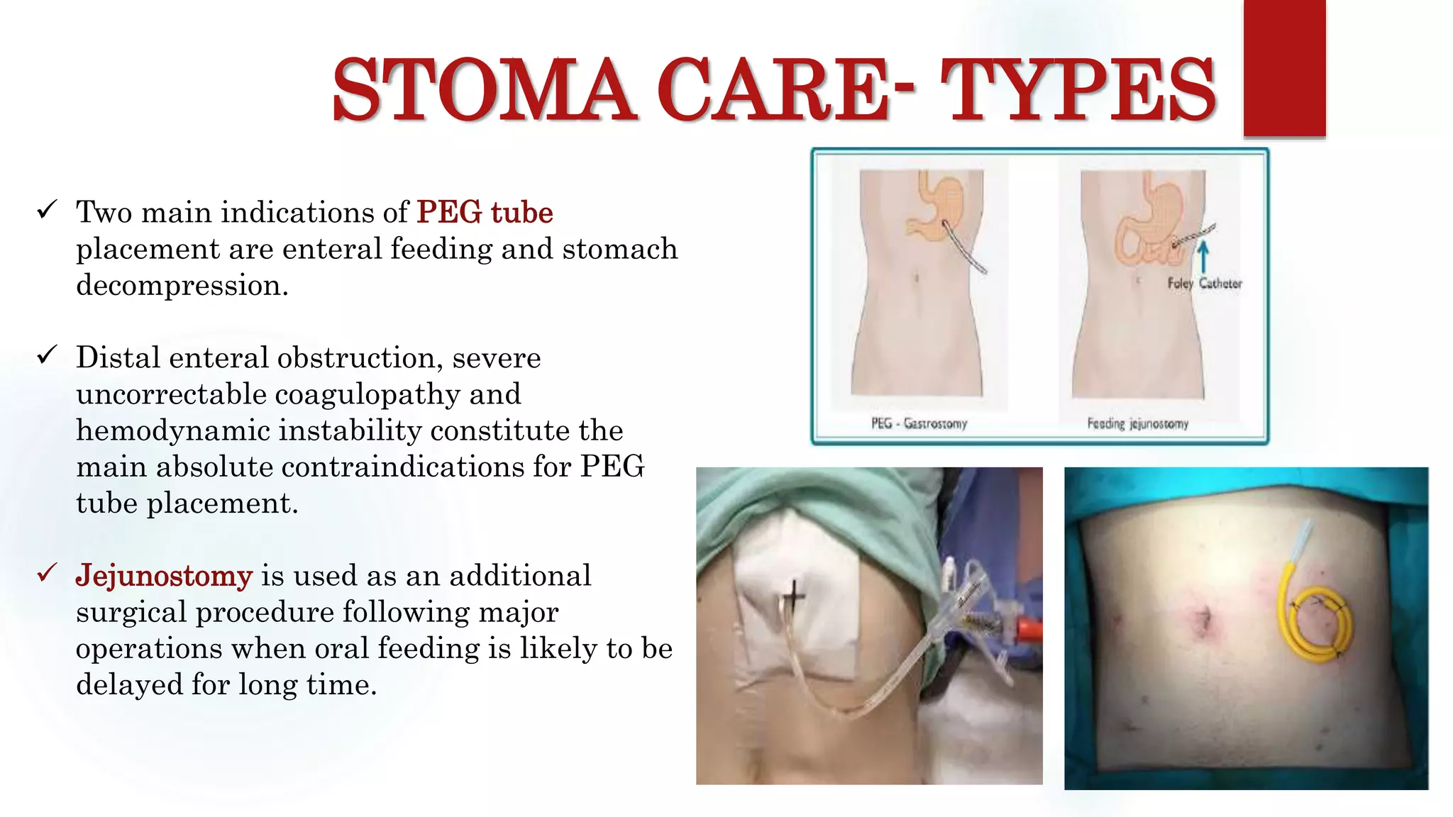 Stoma care / for surgeons | PPTX