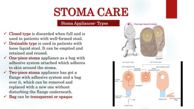 Stoma care / for surgeons | PPTX