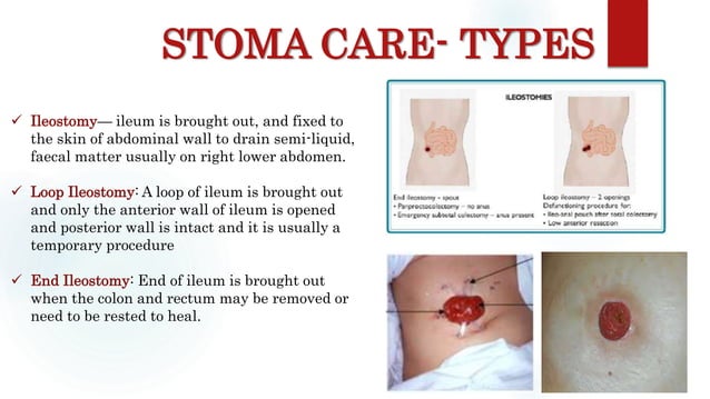 Stoma care / for surgeons | PPTX
