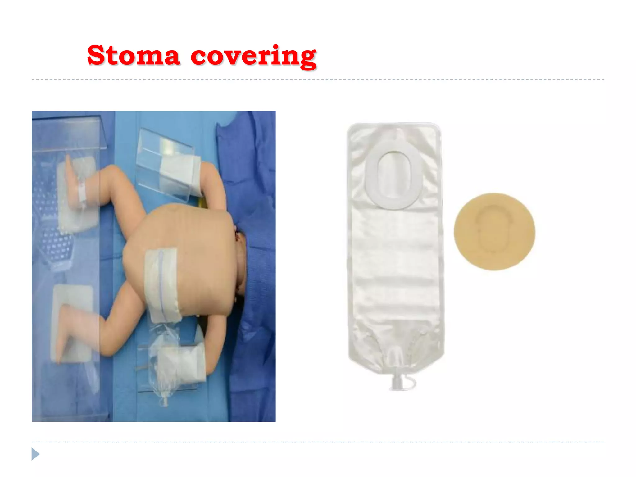 Stoma Care (1).ppt