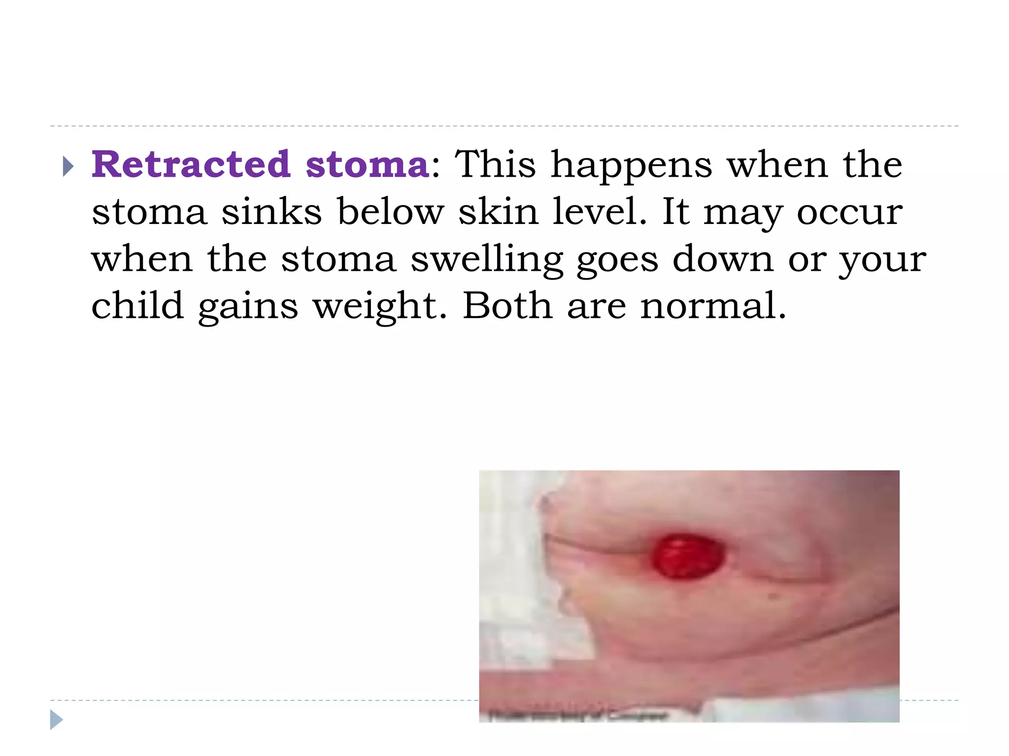 Stoma Care (1).ppt