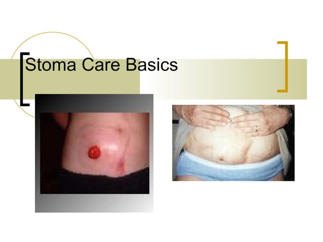 Stoma care basics n | PPT | Digestive Disorders | Diseases and Conditions