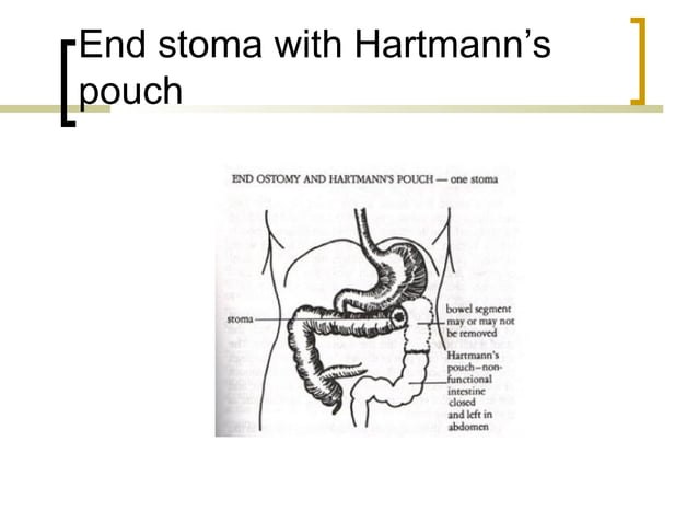 Stoma care basics n | PPT | Digestive Disorders | Diseases and Conditions