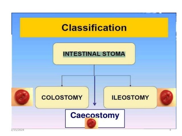 stoma care ppt pediatrics of nursing third grade | PPT