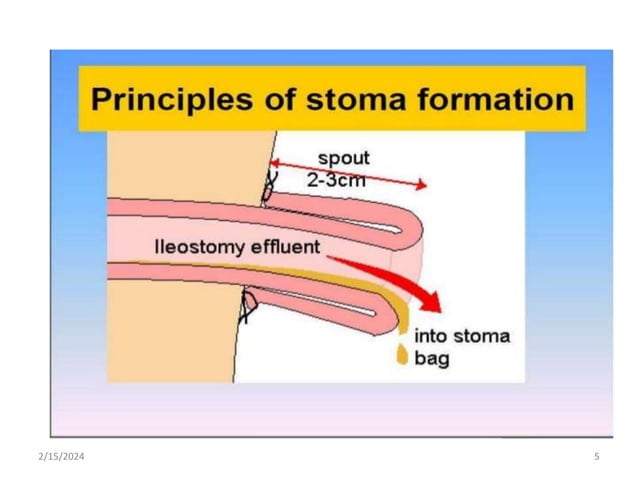 stoma care ppt pediatrics of nursing third grade | PPT