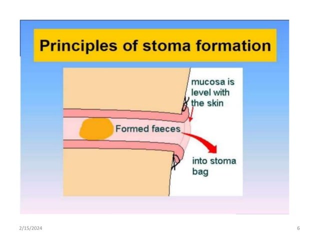 stoma care ppt pediatrics of nursing third grade | PPT