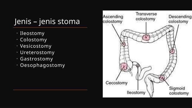 stoma care SSF3rd for nurse and general practitioner.pptx