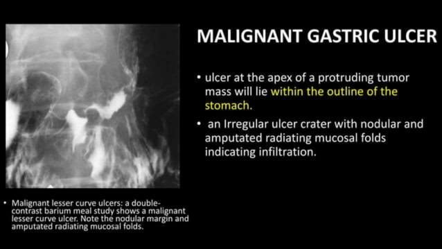 Stomach Radiology Pptx