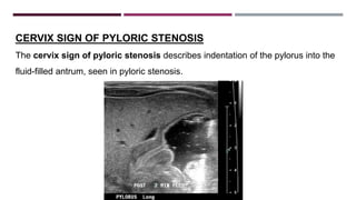 Stomach and duodenum_-_benign_lesions[2] | PPTX