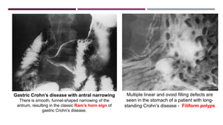 Stomach and duodenum_-_benign_lesions[2] | PPTX