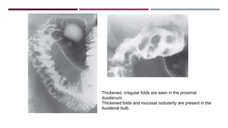 Stomach and duodenum_-_benign_lesions[2] | PPTX