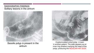 Stomach and duodenum_-_benign_lesions[2] | PPTX