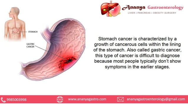 Stomach cancer presentation by Ananya Gastroenterology | PPT
