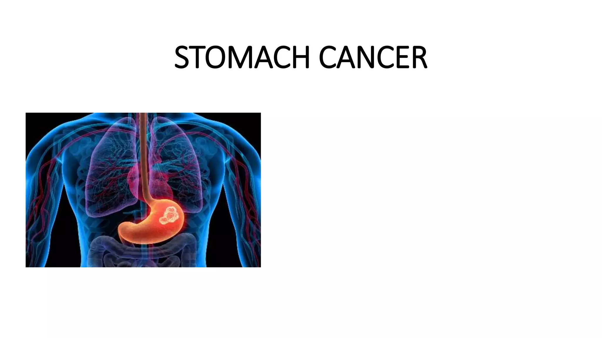 stomach cancer.pptx