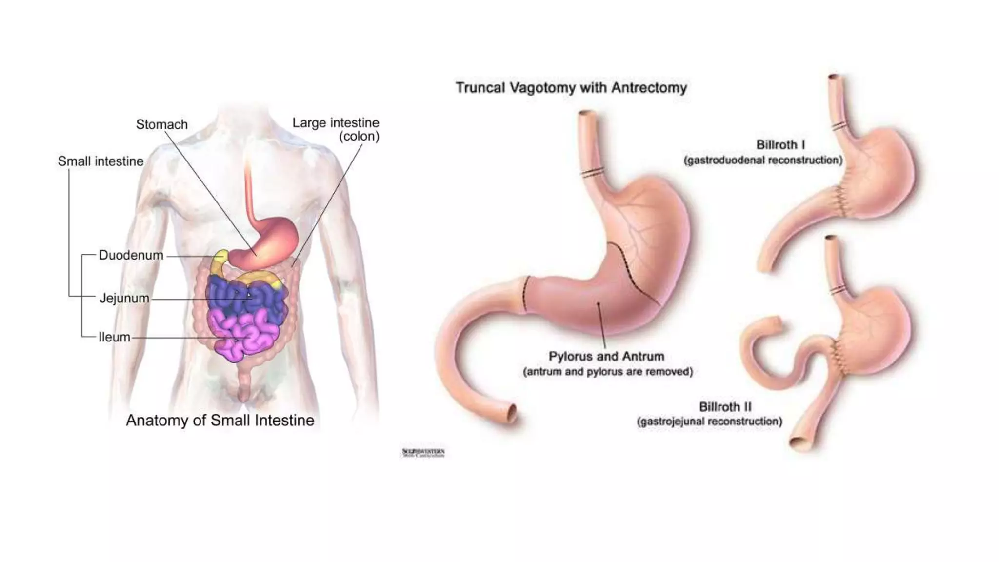 stomach cancer.pptx
