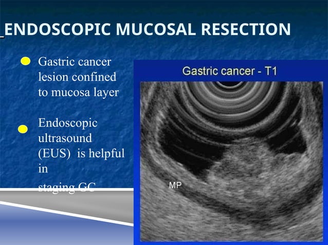 stomach cancer — копия.ppt stomach cancer | PPT