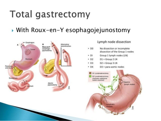 Total Gastrectomy With Roux En Y Esophagojejunostomy Reconstructive