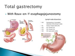 Total Gastrectomy With Roux En Y Esophagojejunostomy