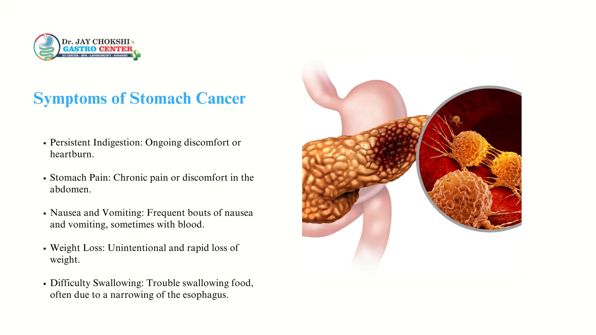 Brief Overview on Stomach Cancer Surgery.pdf