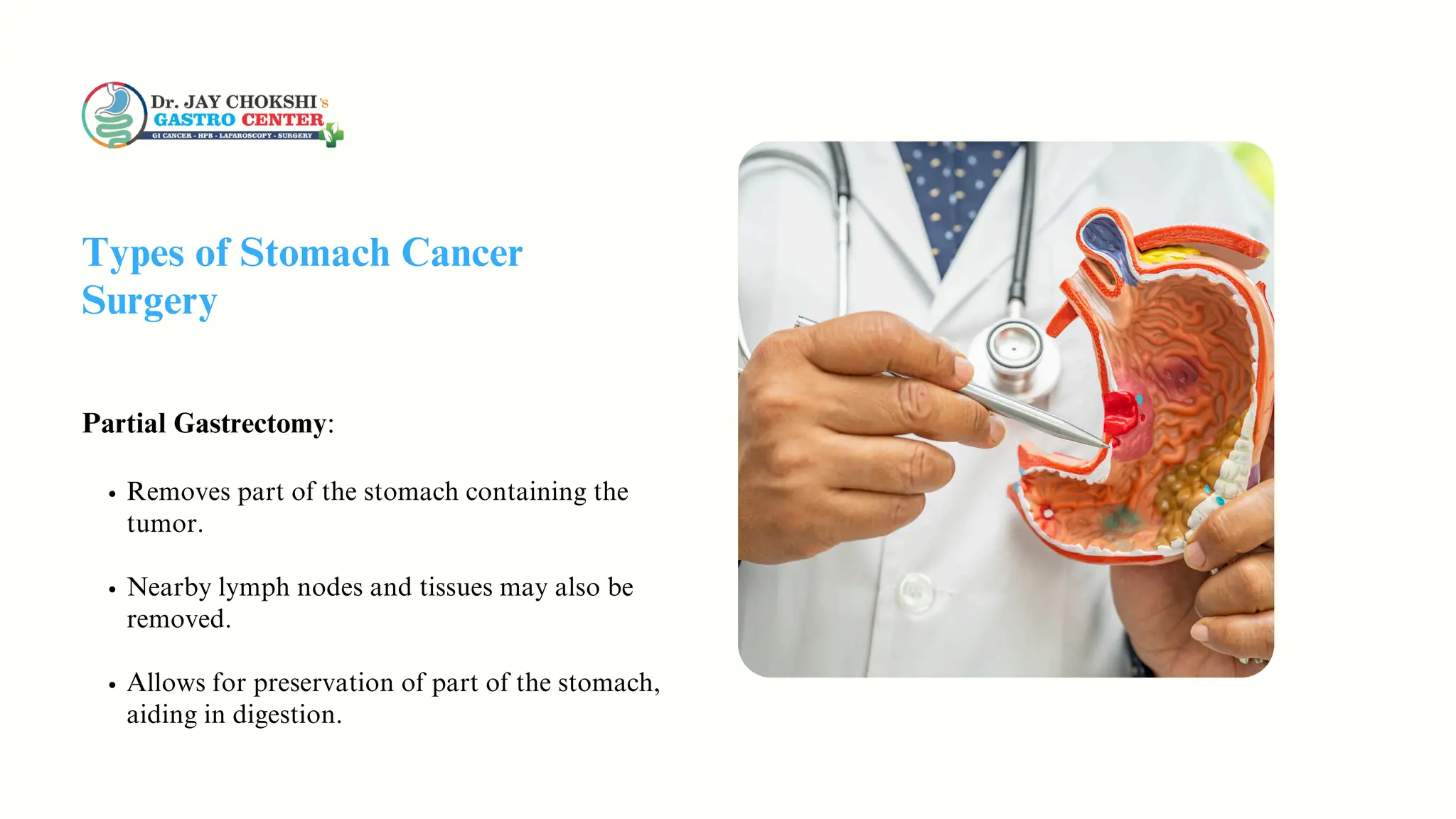 Brief Overview on Stomach Cancer Surgery.pdf