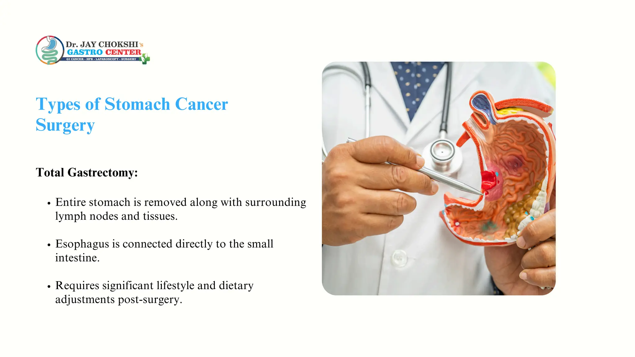 Brief Overview on Stomach Cancer Surgery.pdf
