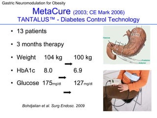Stomach pacemaker for weight loss | PPT