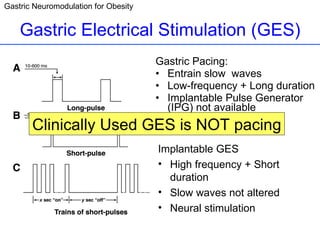 Stomach pacemaker for weight loss | PPT