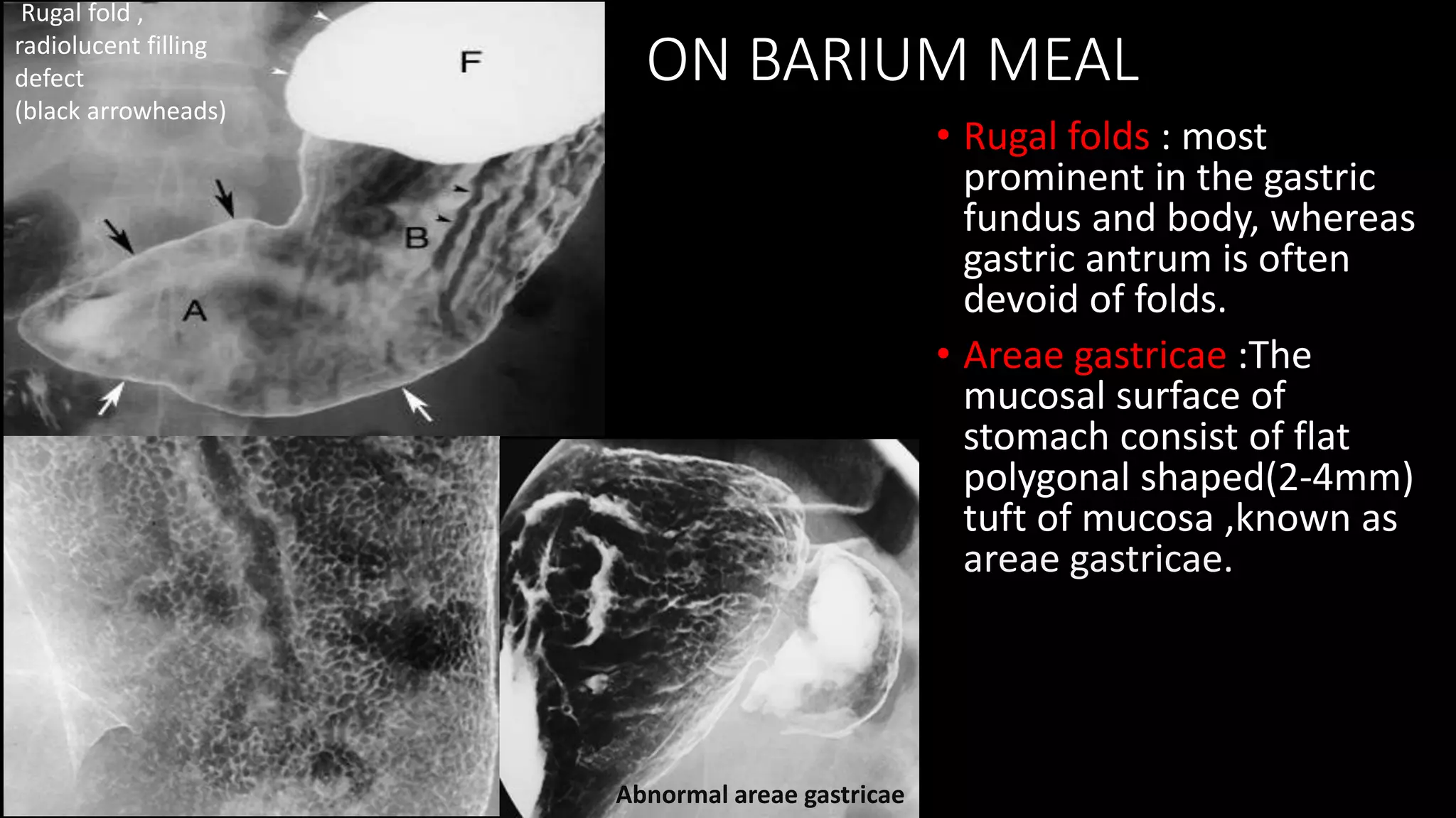 Stomach radiology | PPTX