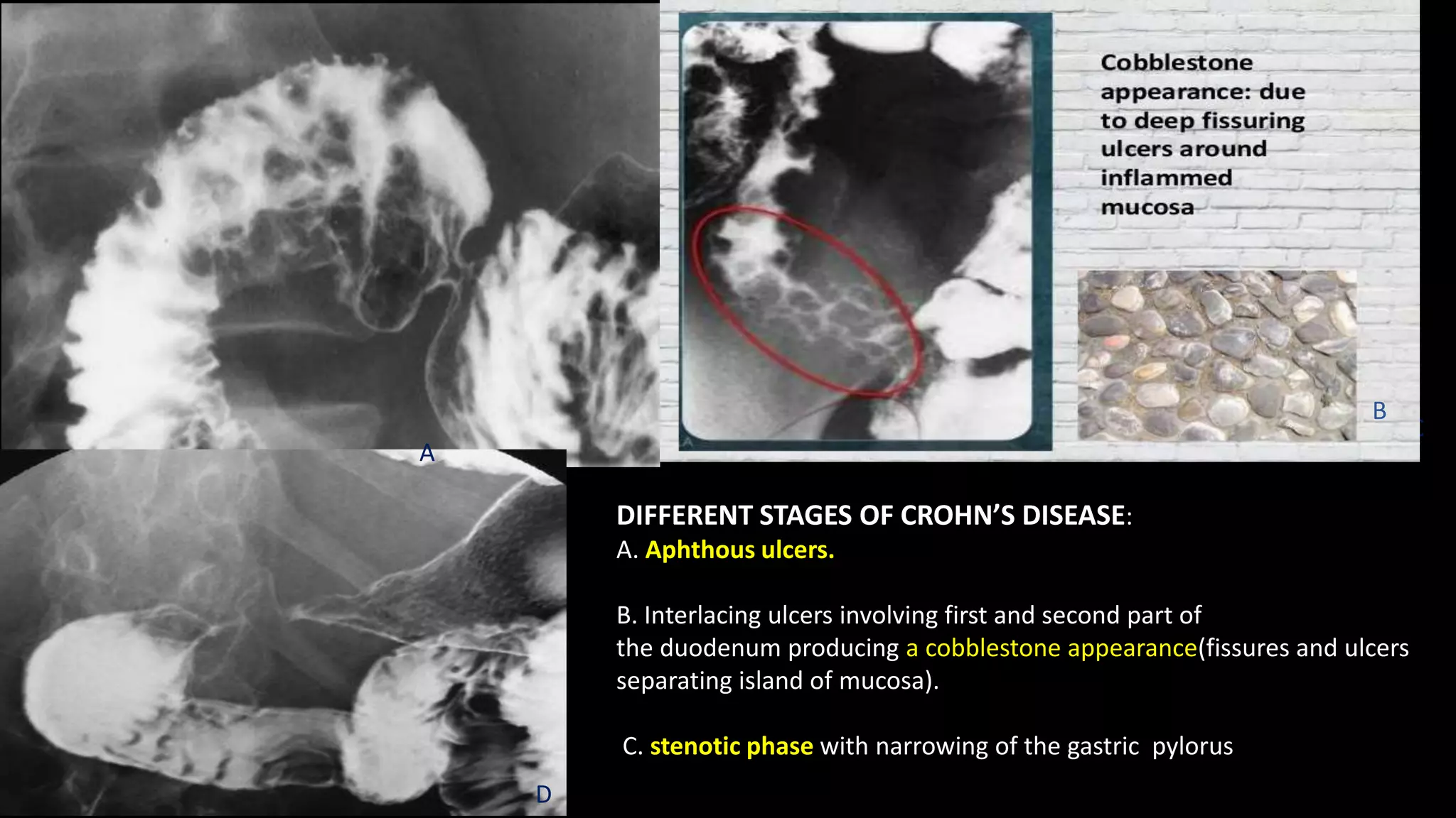 Stomach radiology | PPTX