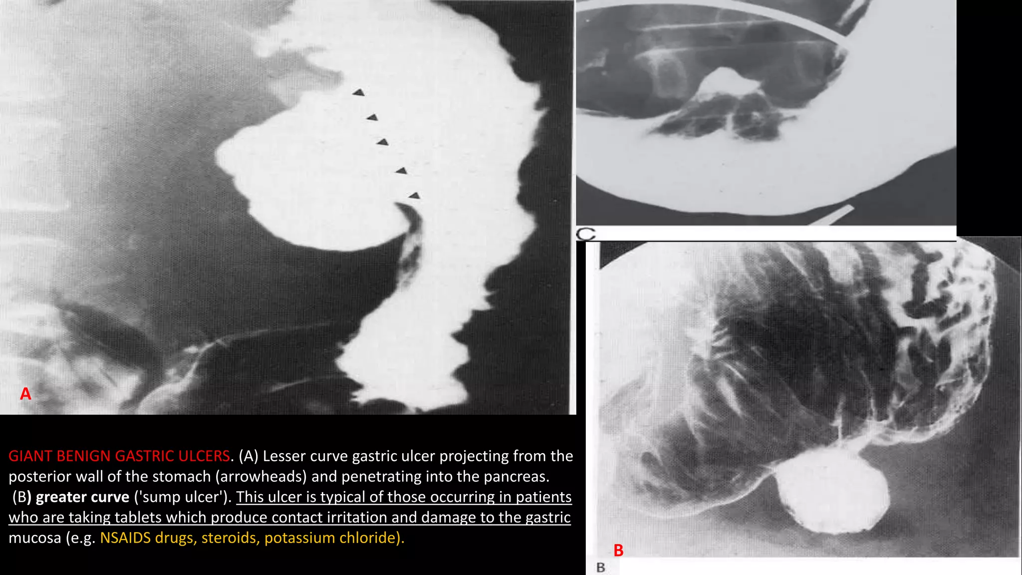 Stomach radiology | PPTX