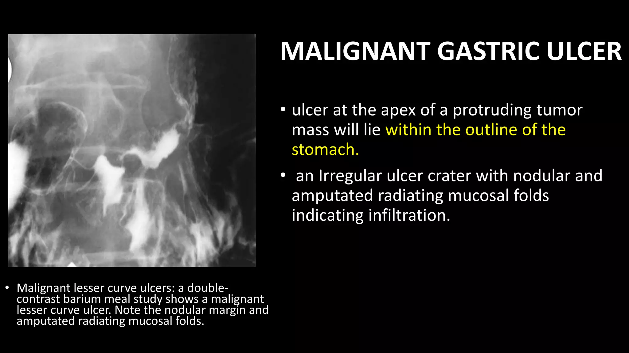 Stomach radiology | PPTX