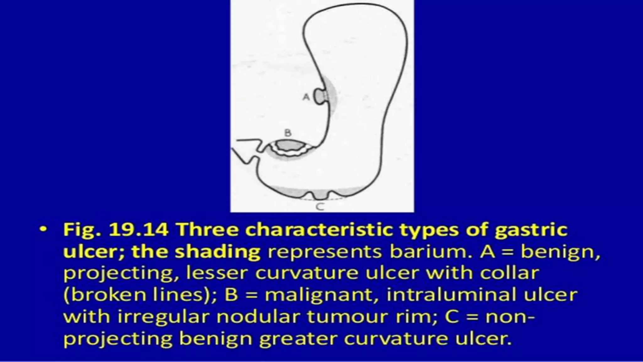 Stomach radiology | PPTX