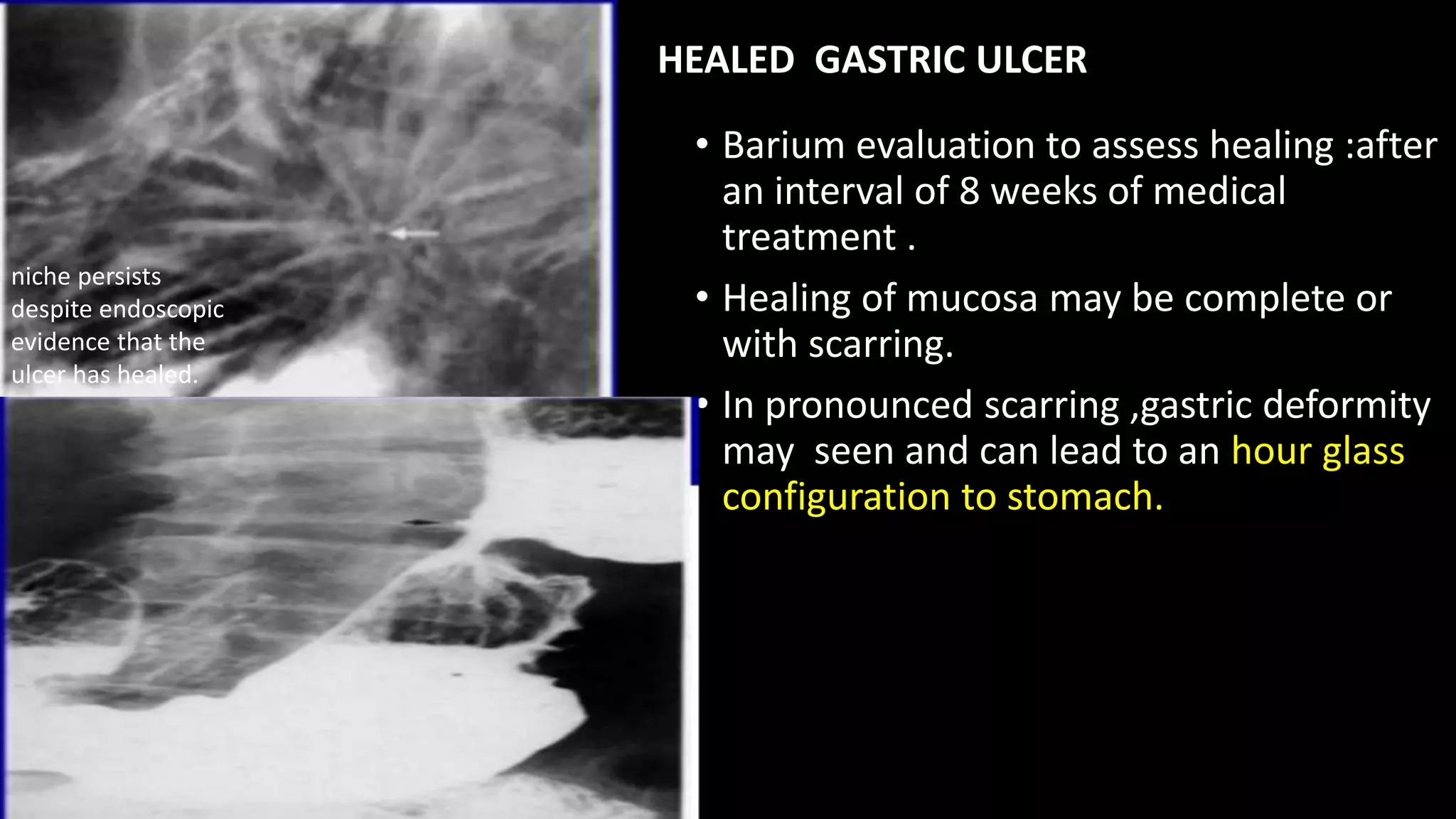 Stomach radiology | PPTX