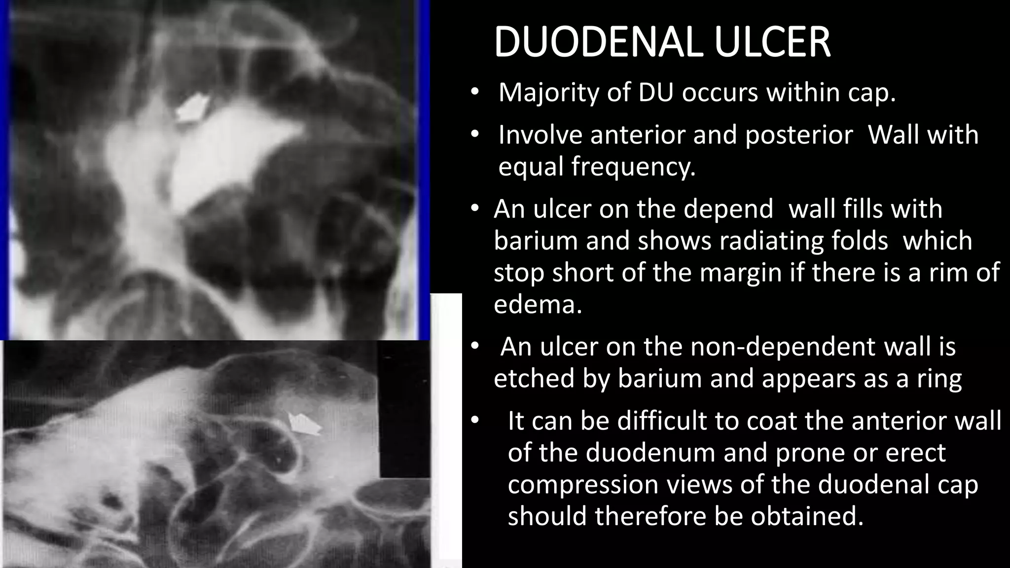 Stomach radiology | PPTX