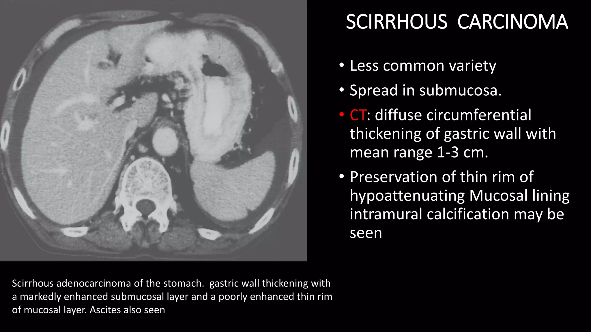 Stomach radiology | PPTX