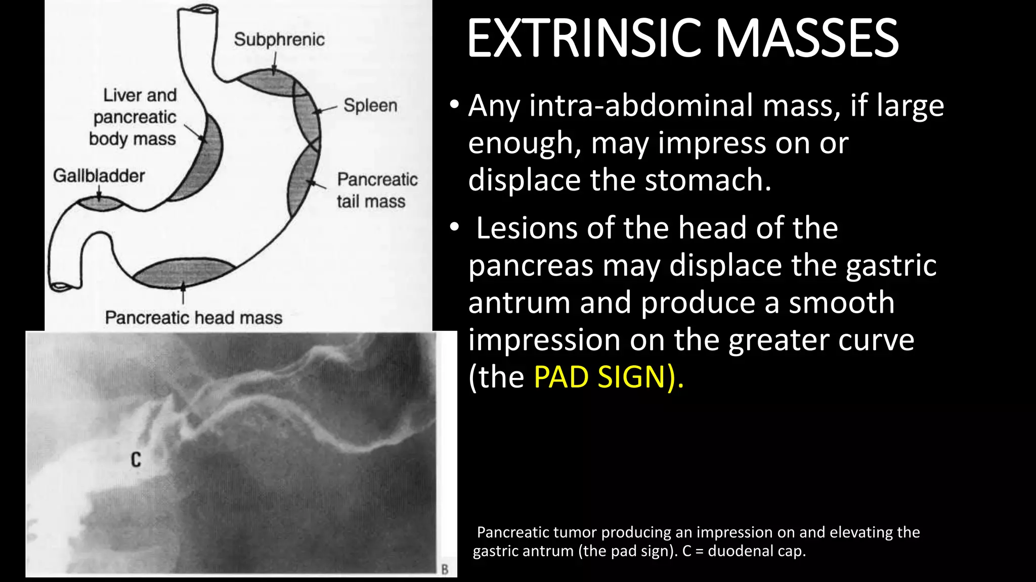Stomach radiology | PPTX