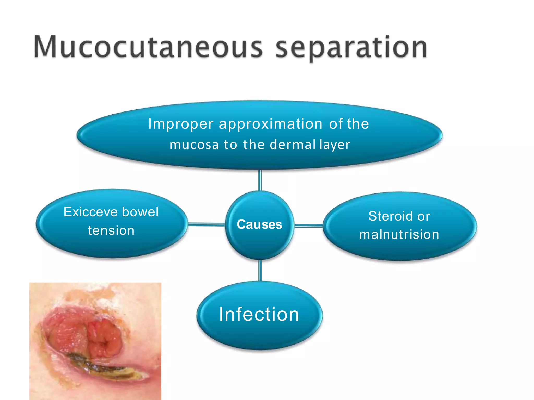 Stoma complications by Prof. Ajay Khanna, IMS, BHU, Varanasi India | PPTX