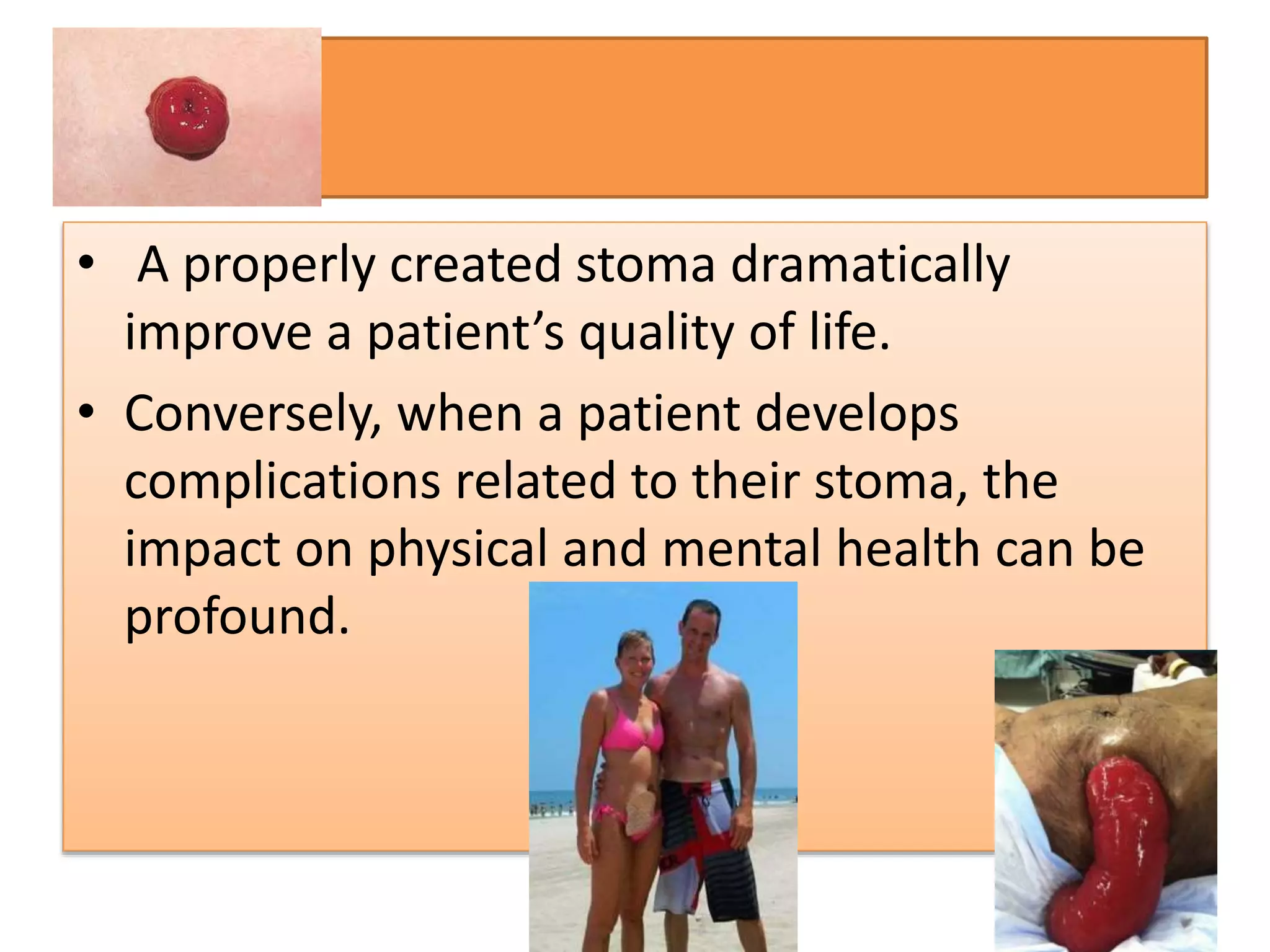 Stoma complications by Prof. Ajay Khanna, IMS, BHU, Varanasi India | PPTX