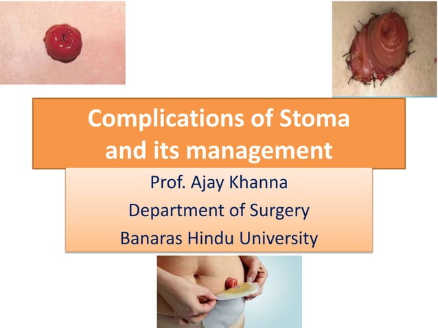 Stoma complications by Prof. Ajay Khanna, IMS, BHU, Varanasi India | PPT